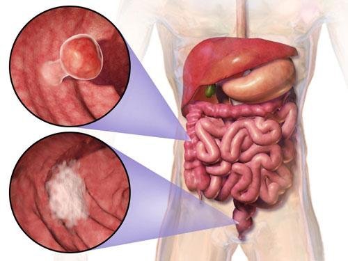 What Can You Expect Before, During, and After Colon Cancer Surgery ...